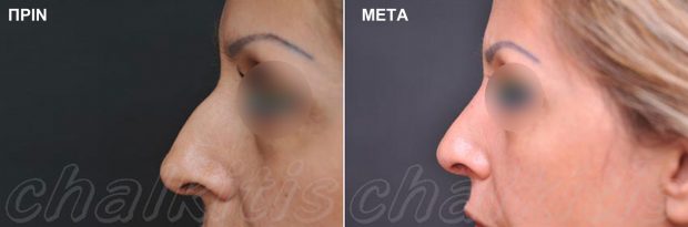 Ρινοπλαστική πλαστική μύτης ανώδυνα με σύντομη ανάρρωση