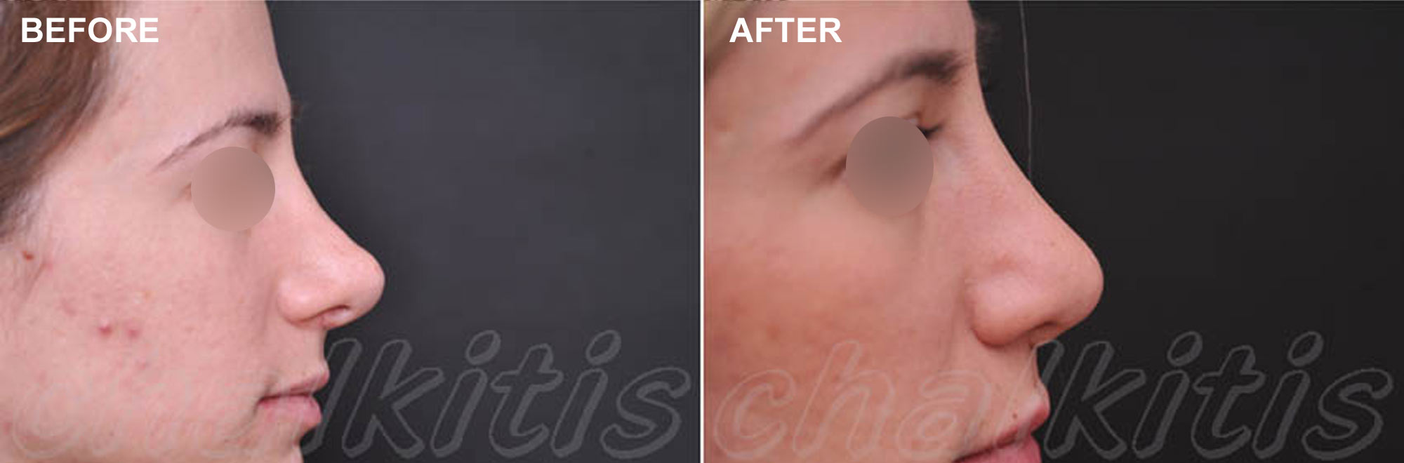 RhinoplastyRhinoplasty